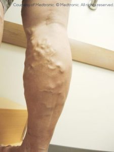 Is apple cider vinegar a treatment for Varicose Veins?