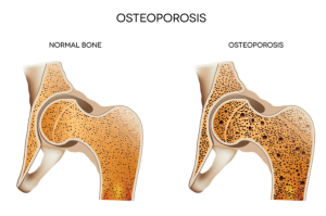 Osteopenia vs. Osteoporosis - Diagnosis & Best Treatments | VIP Medical ...